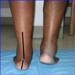 Pes Planus/Adult Acquired Flatfoot Deformity | PM&R KnowledgeNow