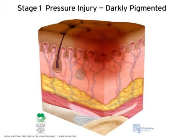 Pressure Injury Management in CNS Disorders | PM&R KnowledgeNow