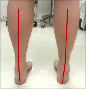 Pes Cavus | PM&R KnowledgeNow