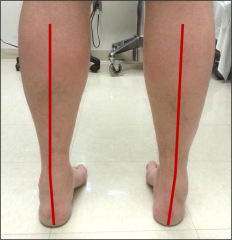 Pes Cavus | PM&R KnowledgeNow