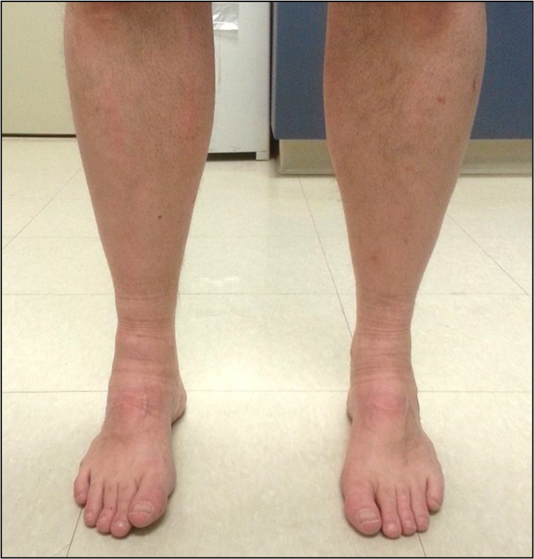 Pes Cavus | PM&R KnowledgeNow