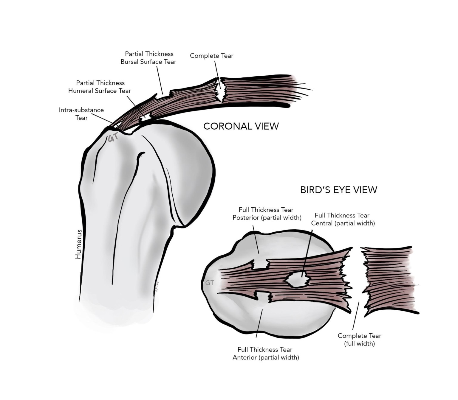 Rotator Cuff Shoulder Tendon and Muscle Injuries | PM&R KnowledgeNow