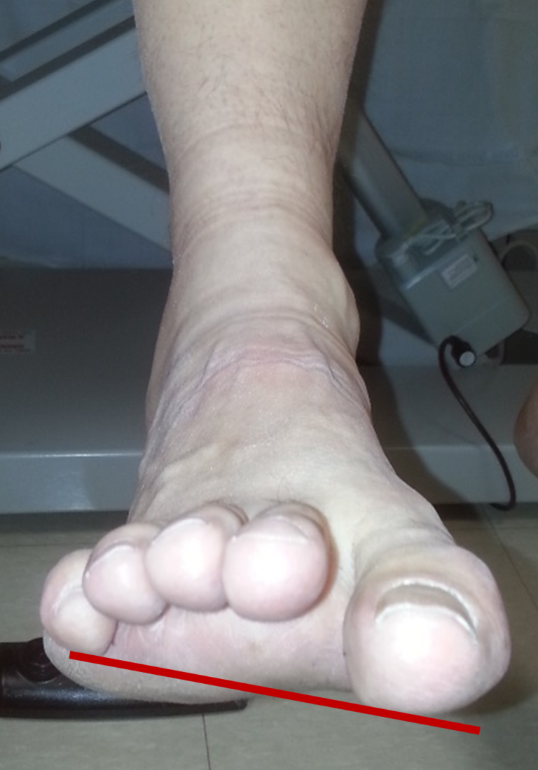 Pes Cavus | PM&R KnowledgeNow