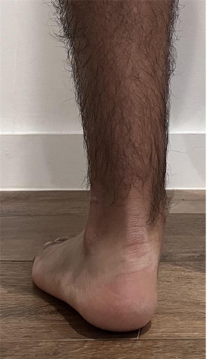 Pes Planus/Adult Acquired Flatfoot Deformity | PM&R KnowledgeNow