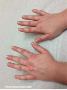 Inflammatory Myopathy | PM&R KnowledgeNow