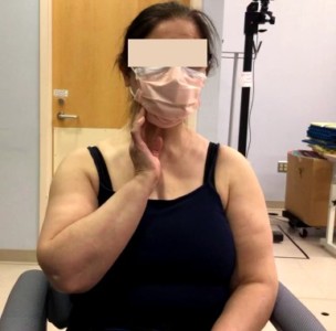 Cervical Dystonia | PM&R KnowledgeNow