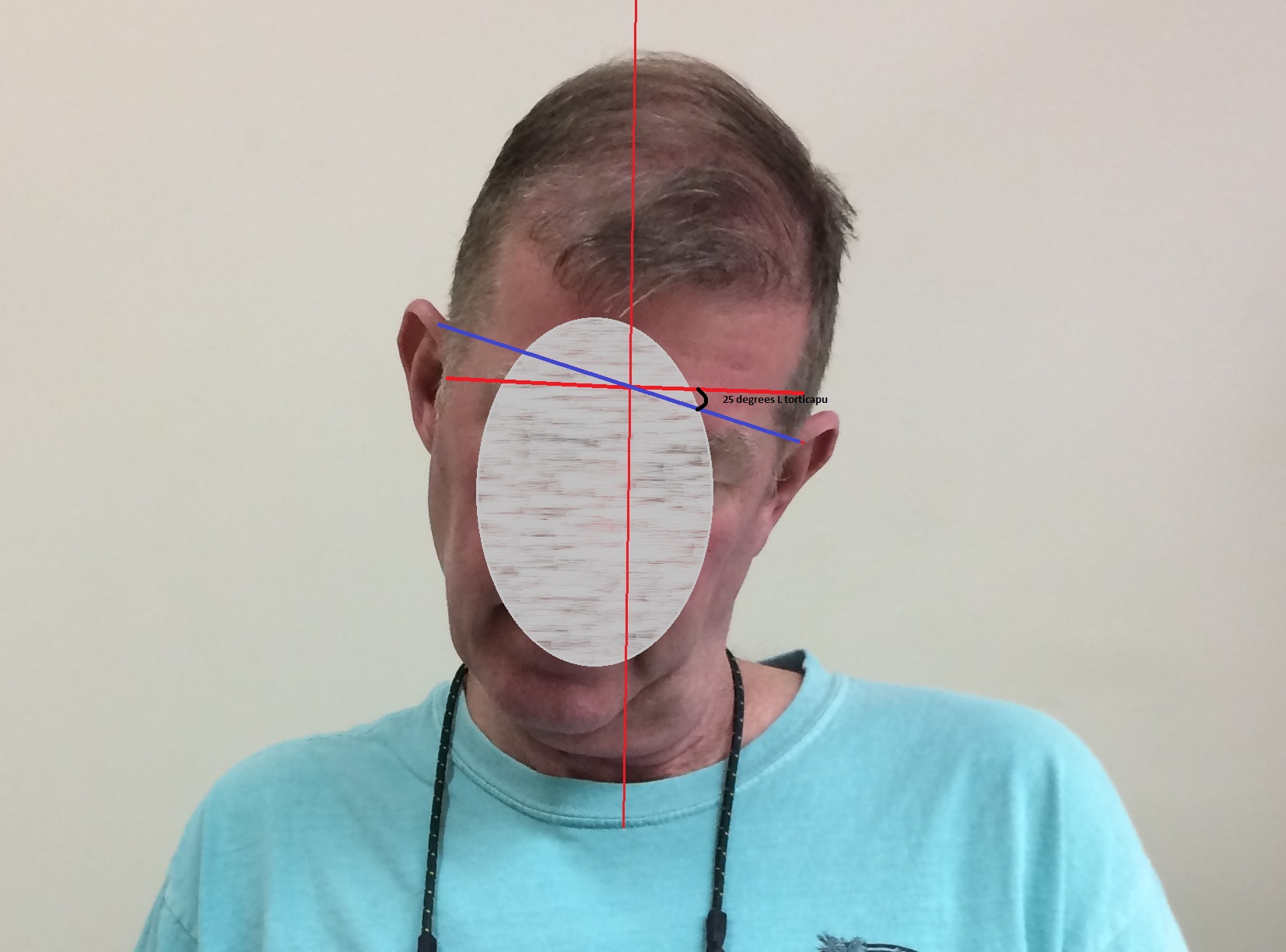 Cervical Dystonia | PM&R KnowledgeNow