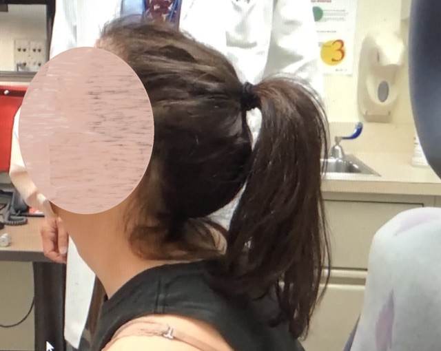 Cervical Dystonia | PM&R KnowledgeNow