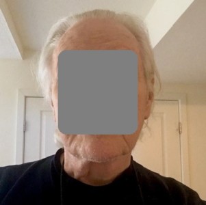 Cervical Dystonia | PM&R KnowledgeNow