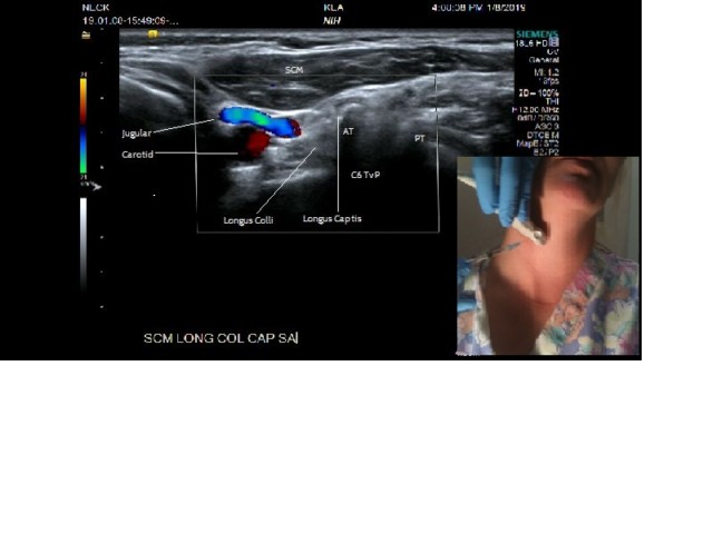 Cervical Dystonia | PM&R KnowledgeNow