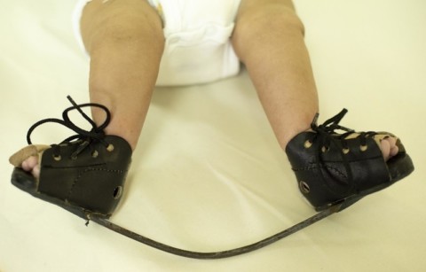 Club Foot | PM&R KnowledgeNow